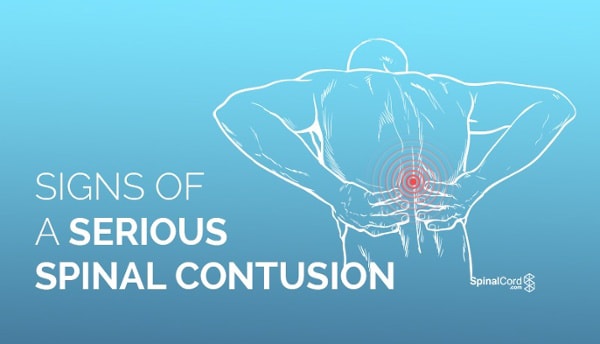 Spinal Contusion (Bruised Spine): Symptoms, Risks & Recovery
