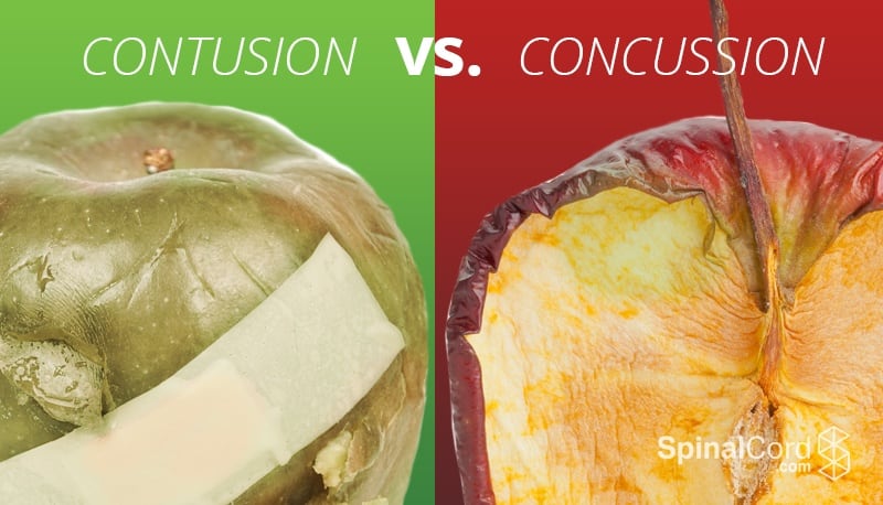 Contusion vs. Concussion: Symptoms, Causes, and Treatment