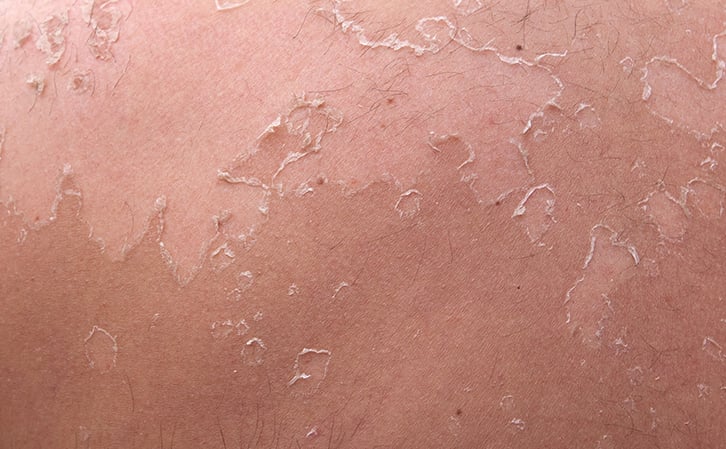 Why Not Being Able to Walk Isn’t the Worst Aspect of Paralysis