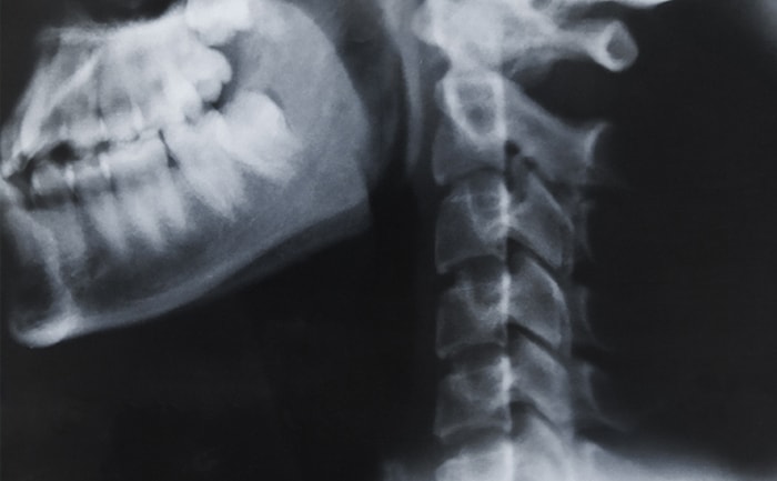 C1 & C2 Vertebrae Spinal Cord Injury | SpinalCord.com