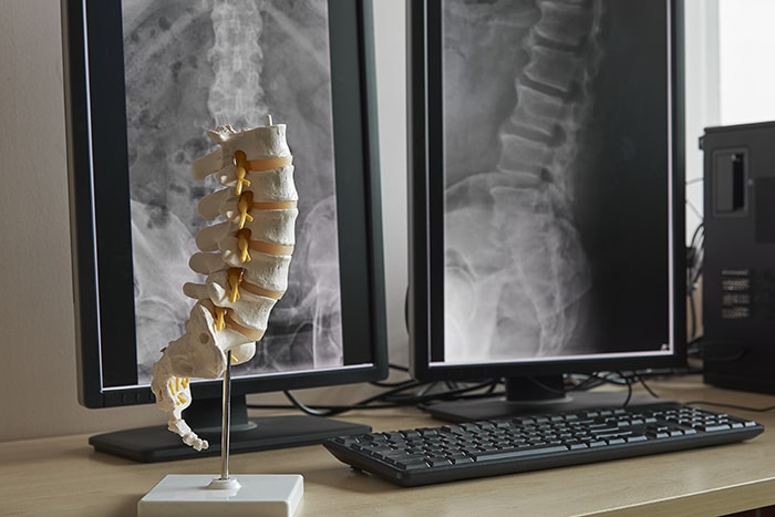 Sacral Spine Injuries (S1–S5): Symptoms, Nerve Damage & Recovery