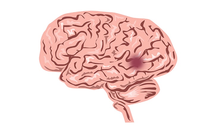 Brain Hemorrhage Recovery Time, Causes, and Symptoms