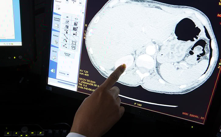 What Happens After A Lack of Oxygen to the Brain?