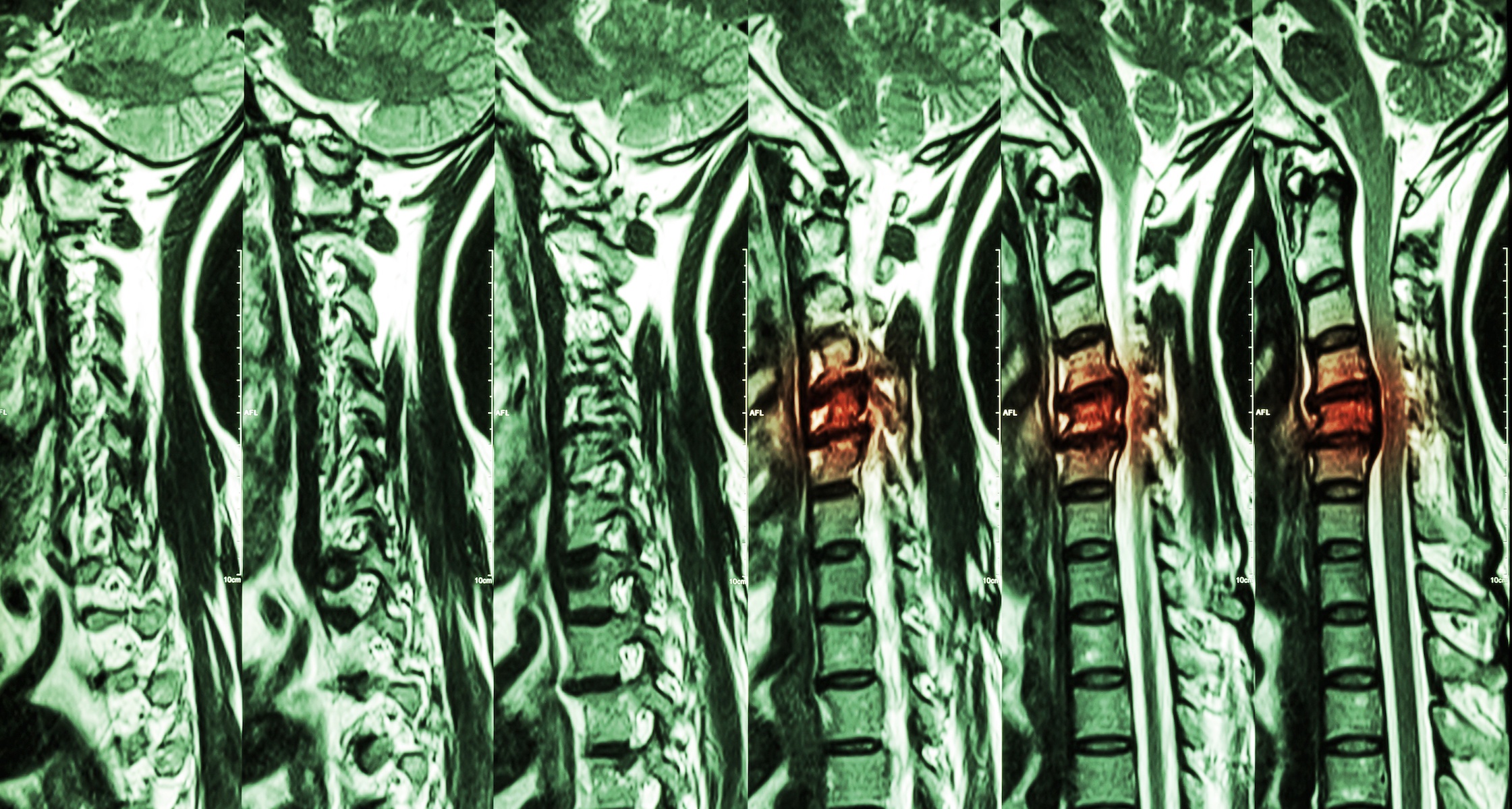 What Are the Most Common Types of Spinal Cord Injuries?