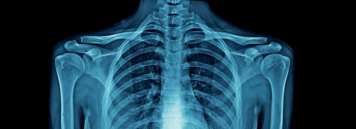 T1 - T8 Vertebrae Spinal Cord Injury | SpinalCord.com